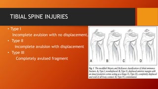 PROXIMAL TIBIAL FRACTURE.pptx