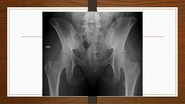 Proyección de pelvis inlet outlet