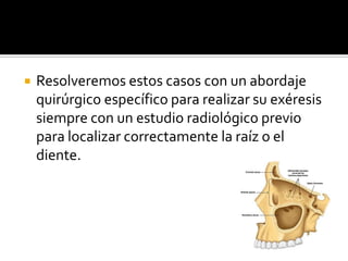 Proyección de resto radicular a seno maxilar | PPTX