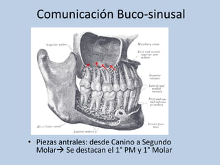 Proyección resto radicular al seno maxilar | PPTX