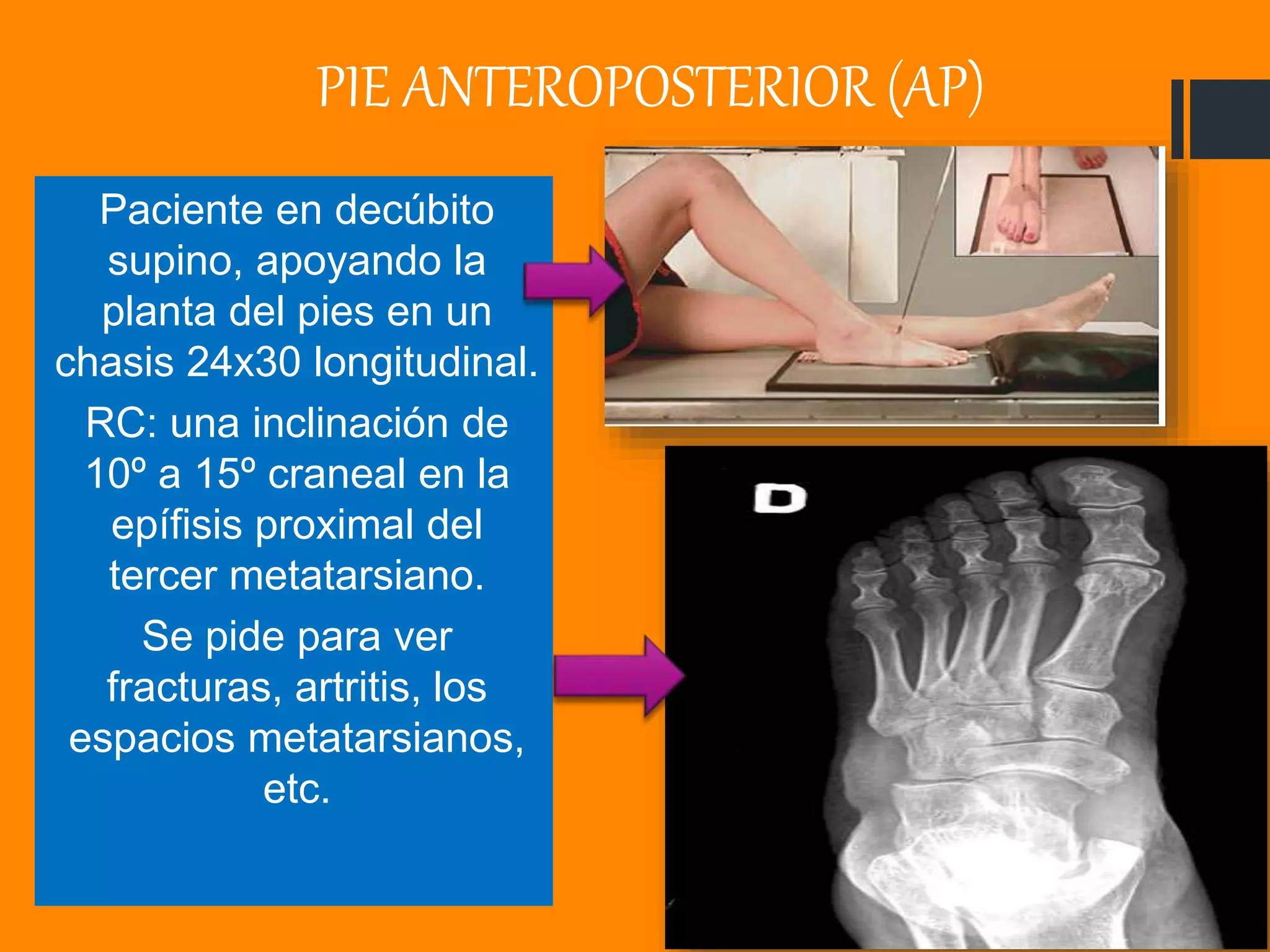 Proyeccion ap, lateral y oblicua del pie | PPTX