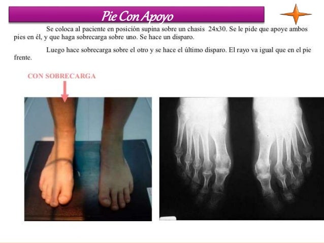 Proyeccion ap, lateral y oblicua del pie