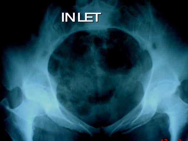 rx Pelvis.proyec.no convencionales-Lic.Juan Jose MOntico -Argentina ...