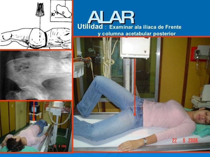 rx Pelvis.proyec.no convencionales-Lic.Juan Jose MOntico -Argentina.C…