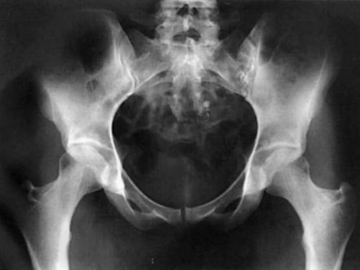 rx Pelvis.proyec.no convencionales-Lic.Juan Jose MOntico -Argentina.C…