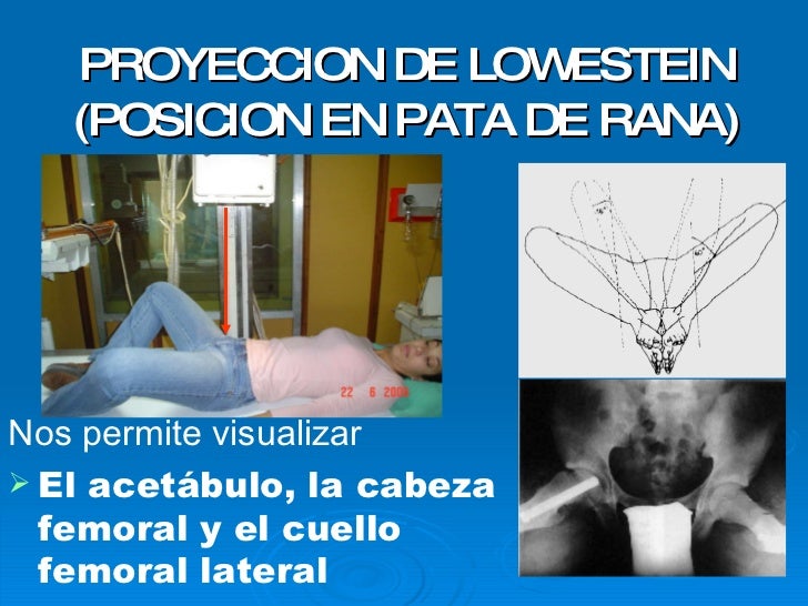rx Pelvis.proyec.no convencionales-Lic.Juan Jose MOntico -Argentina.C…