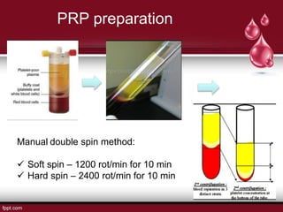 platelet rich plasma | PPTX