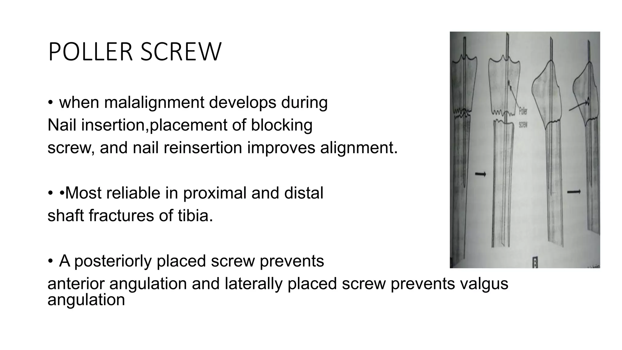 Intramedullary nailing.pptx