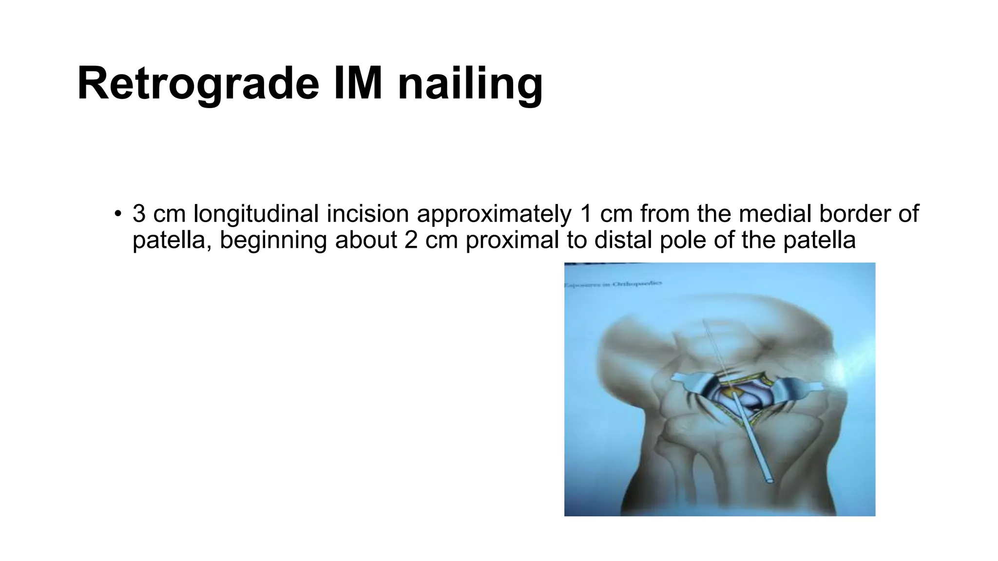 Intramedullary nailing.pptx