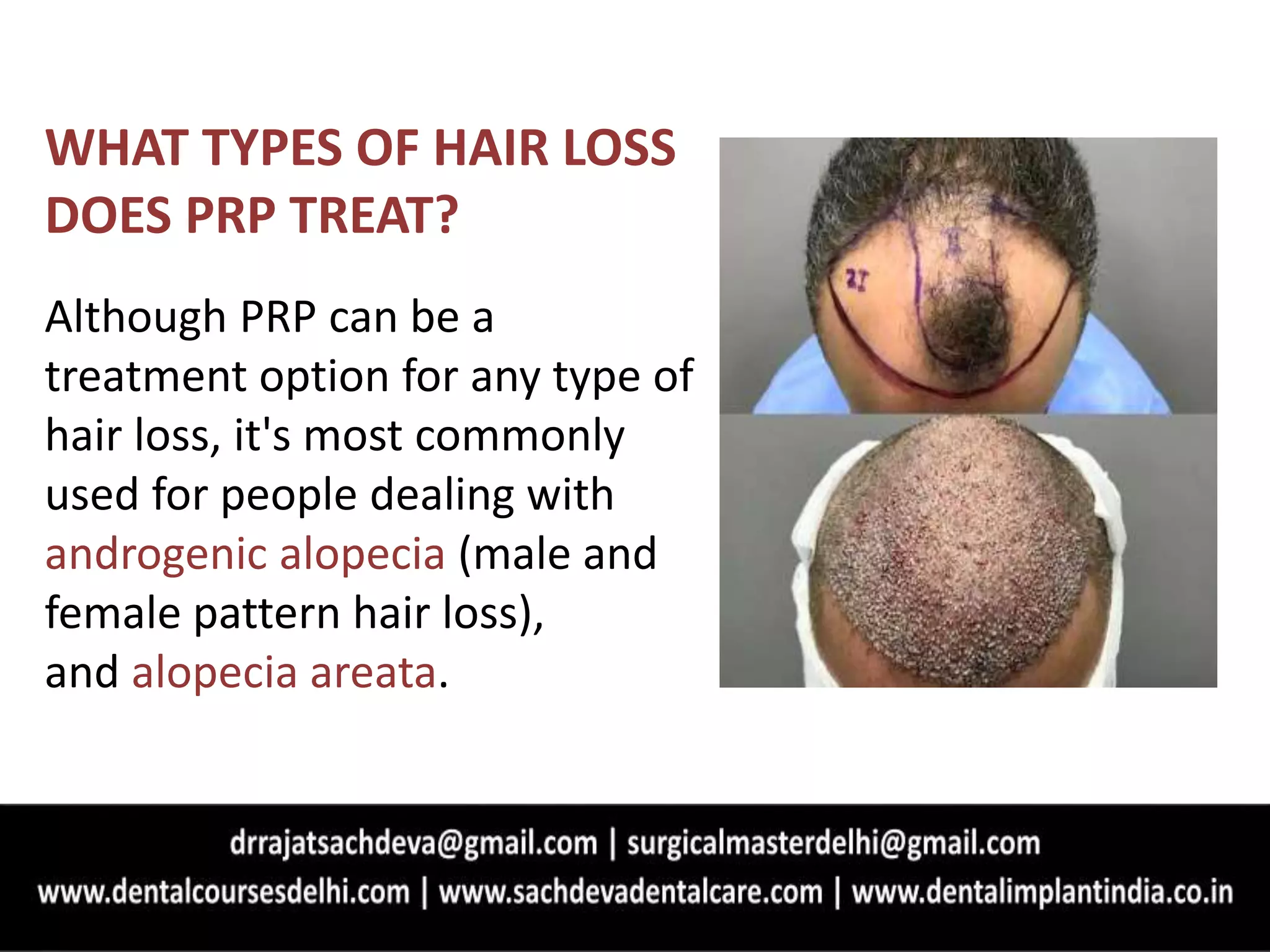 Prp for hair regrowth | PPTX
