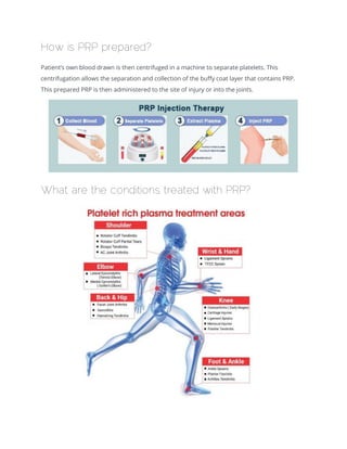 Prp injections in orthopedics | PDF
