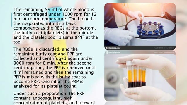 PRP in Orthodontics | PPTX | Dental Health | Diseases and Conditions
