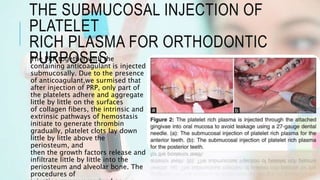 PRP in Orthodontics | PPTX