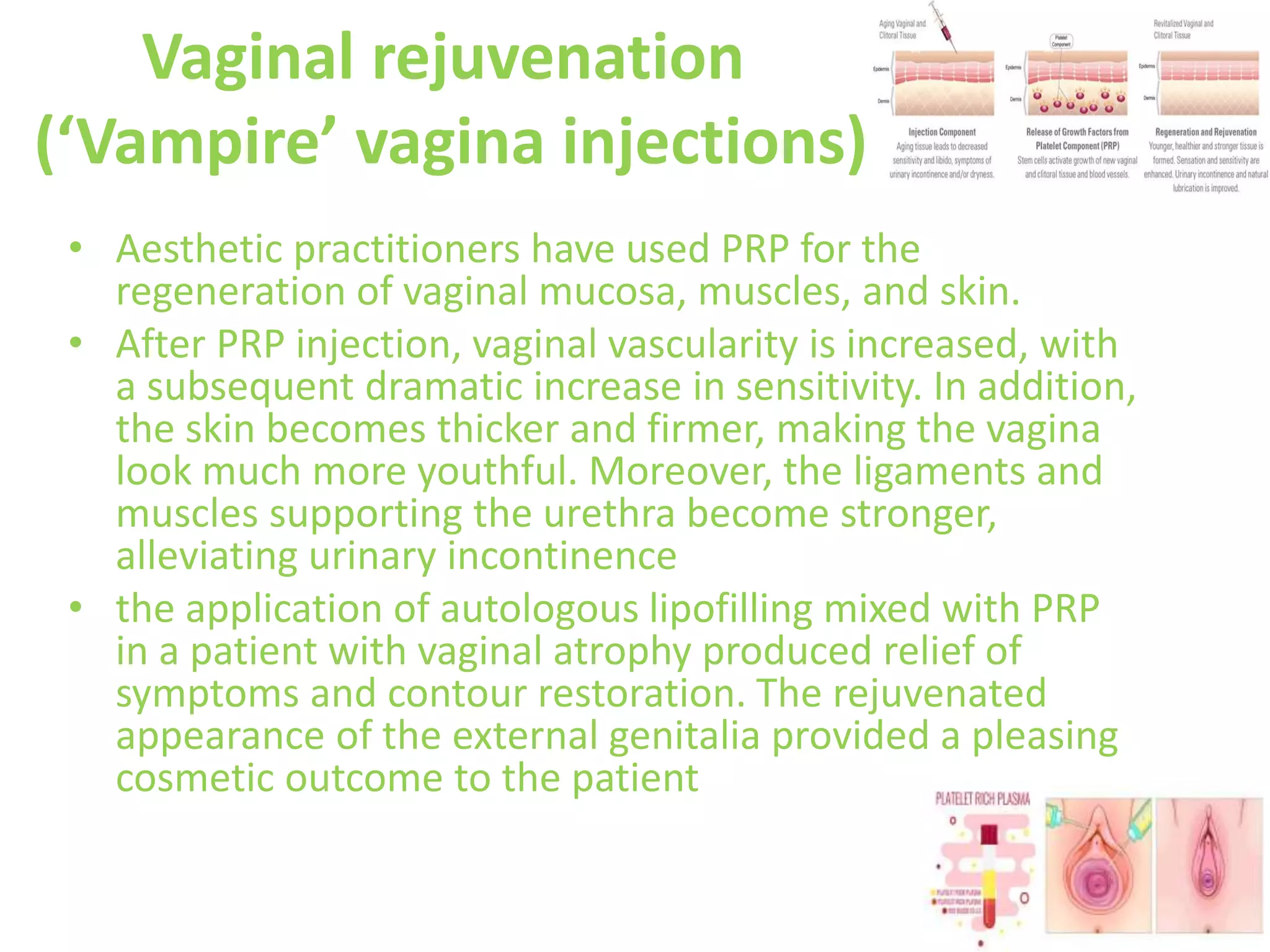 platelet rich plasma intimate female ttt | PPT