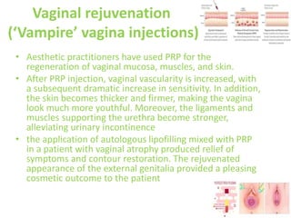 platelet rich plasma intimate female ttt | PPTX