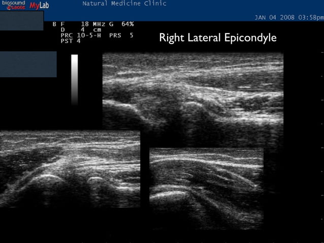 Prp Matrix Grafts | PPT
