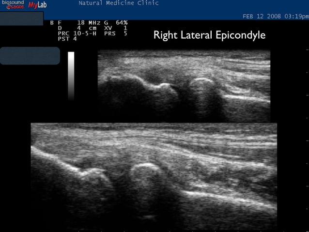 Prp Matrix Grafts | PPT