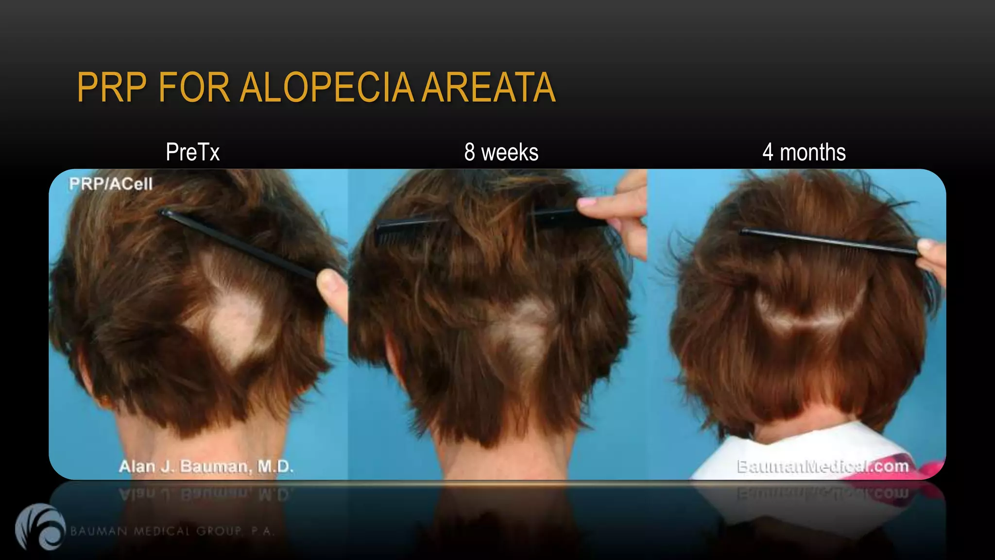 PRP Platelet Rich Plasma for Hair Regrowth by Dr. Alan Bauman | PPTX