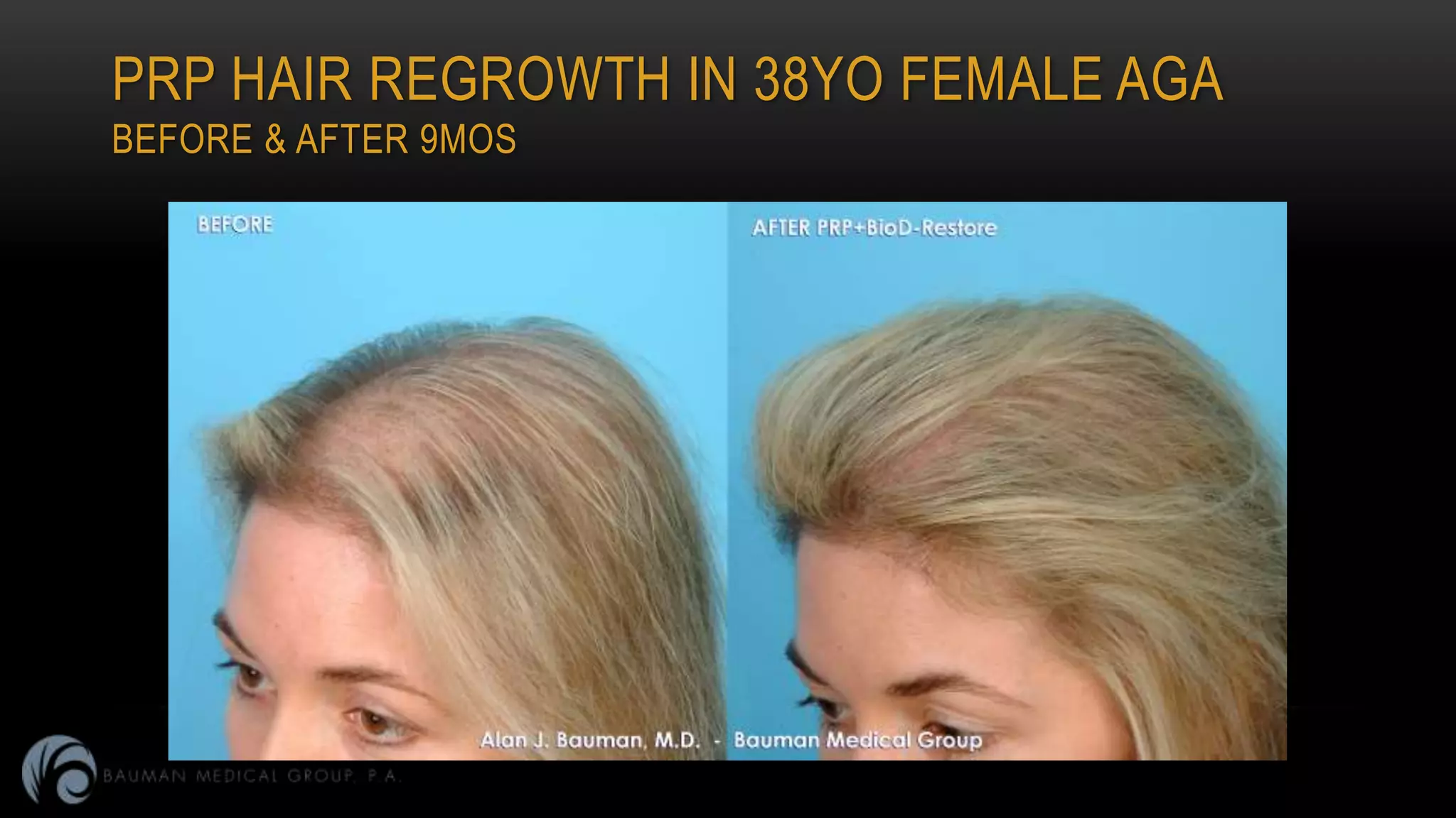 PRP Platelet Rich Plasma for Hair Regrowth by Dr. Alan Bauman | PPTX