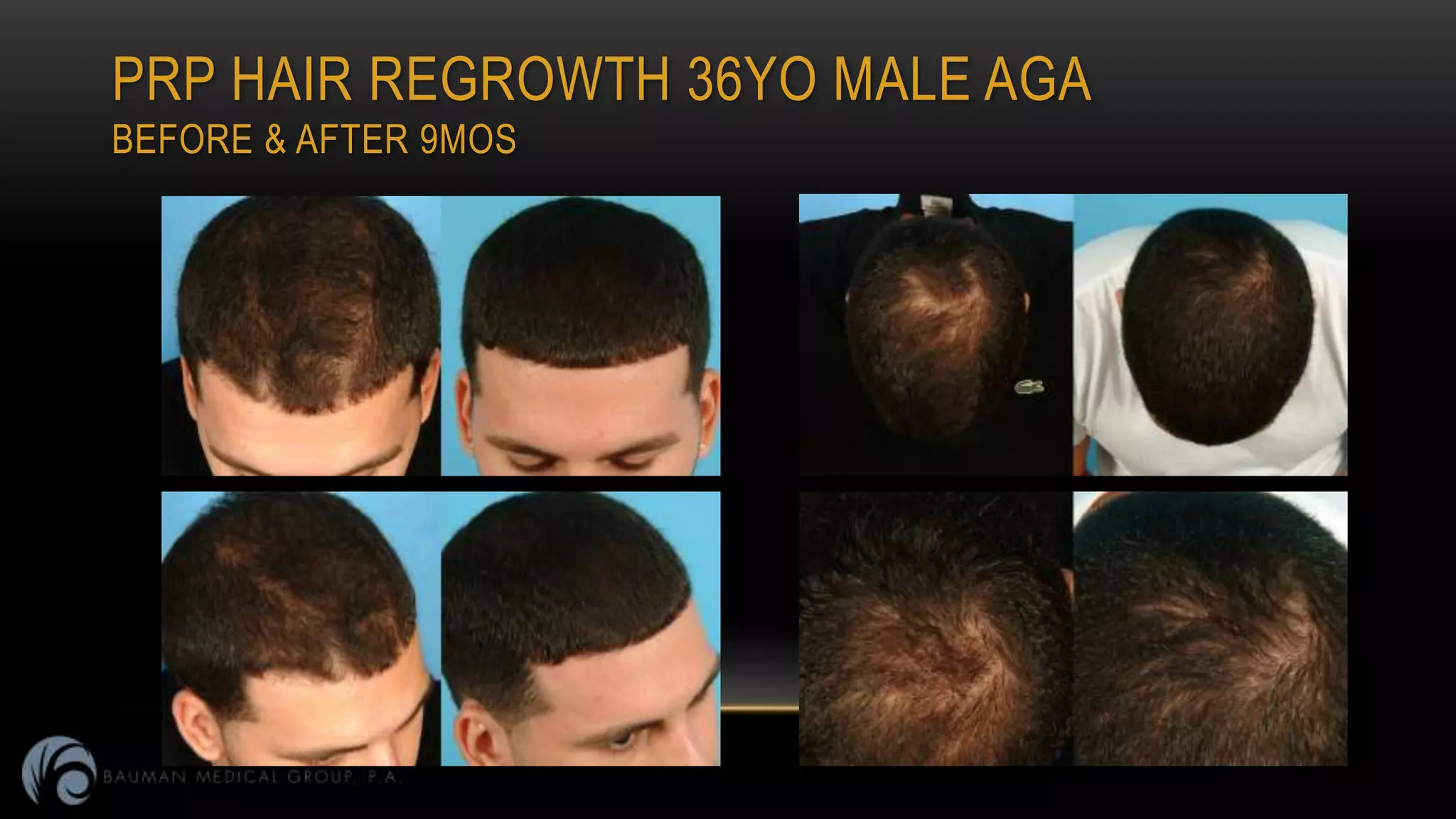 PRP Platelet Rich Plasma for Hair Regrowth by Dr. Alan Bauman | PPTX