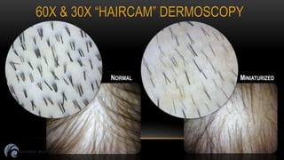 PRP Platelet Rich Plasma for Hair Regrowth by Dr. Alan Bauman | PPTX