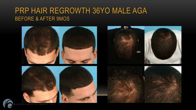 PRP Platelet Rich Plasma for Hair Regrowth by Dr. Alan Bauman | PPTX ...