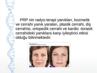 PRP (Platelet-Rich Plasma) | ODP