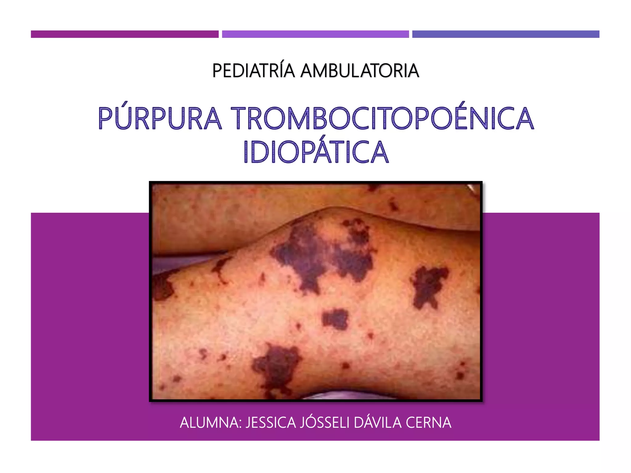 Púrpura trombocitopénica idiopática | PPTX