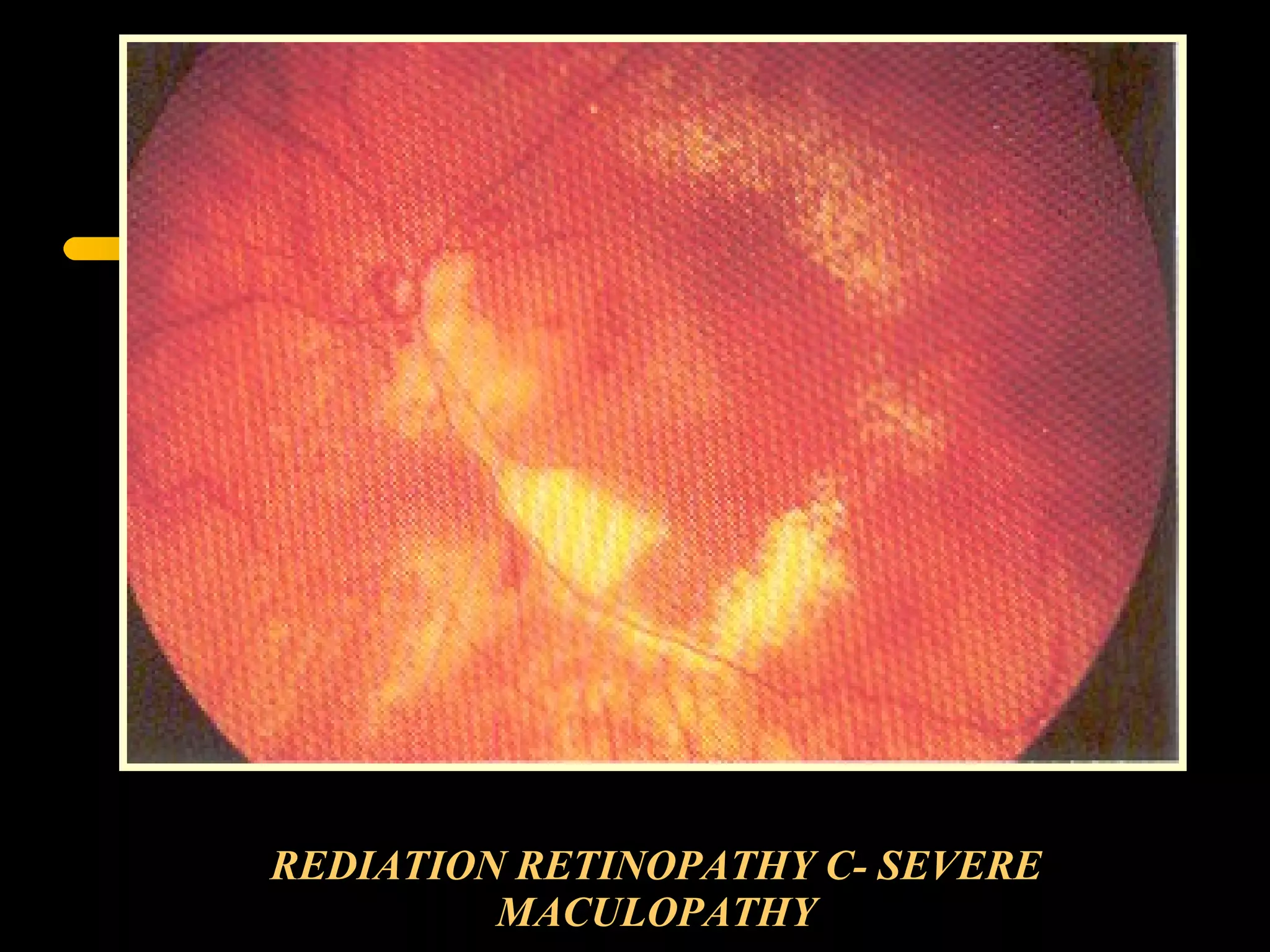 Radiation Injuries To Eye | PPT
