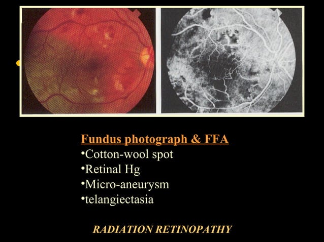 Radiation Injuries To Eye | PPT | Eye and Vision Conditions | Diseases ...