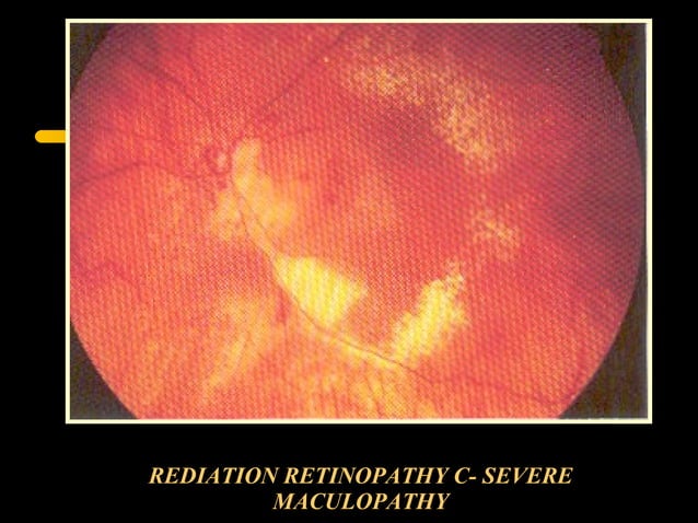 Radiation Injuries To Eye | PPT | Eye and Vision Conditions | Diseases ...