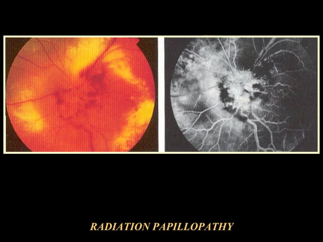 Radiation Injuries To Eye | PPT | Eye and Vision Conditions | Diseases ...