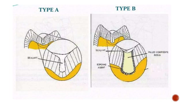 Atraumatic restoration technique and preservative restoration technique ...
