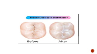 Atraumatic restoration technique and preservative restoration technique ...