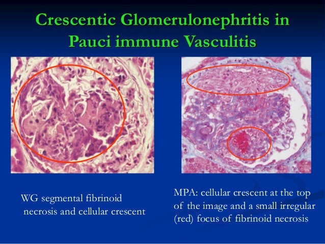 Pulmonary Renal Syndorme