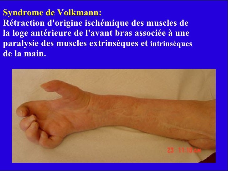 fractures diaphysaires des os de l'avant bras