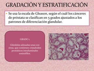 HIPERPLASIA NODULAR Y CARCINOMA DE PRÓSTATA | PPTX