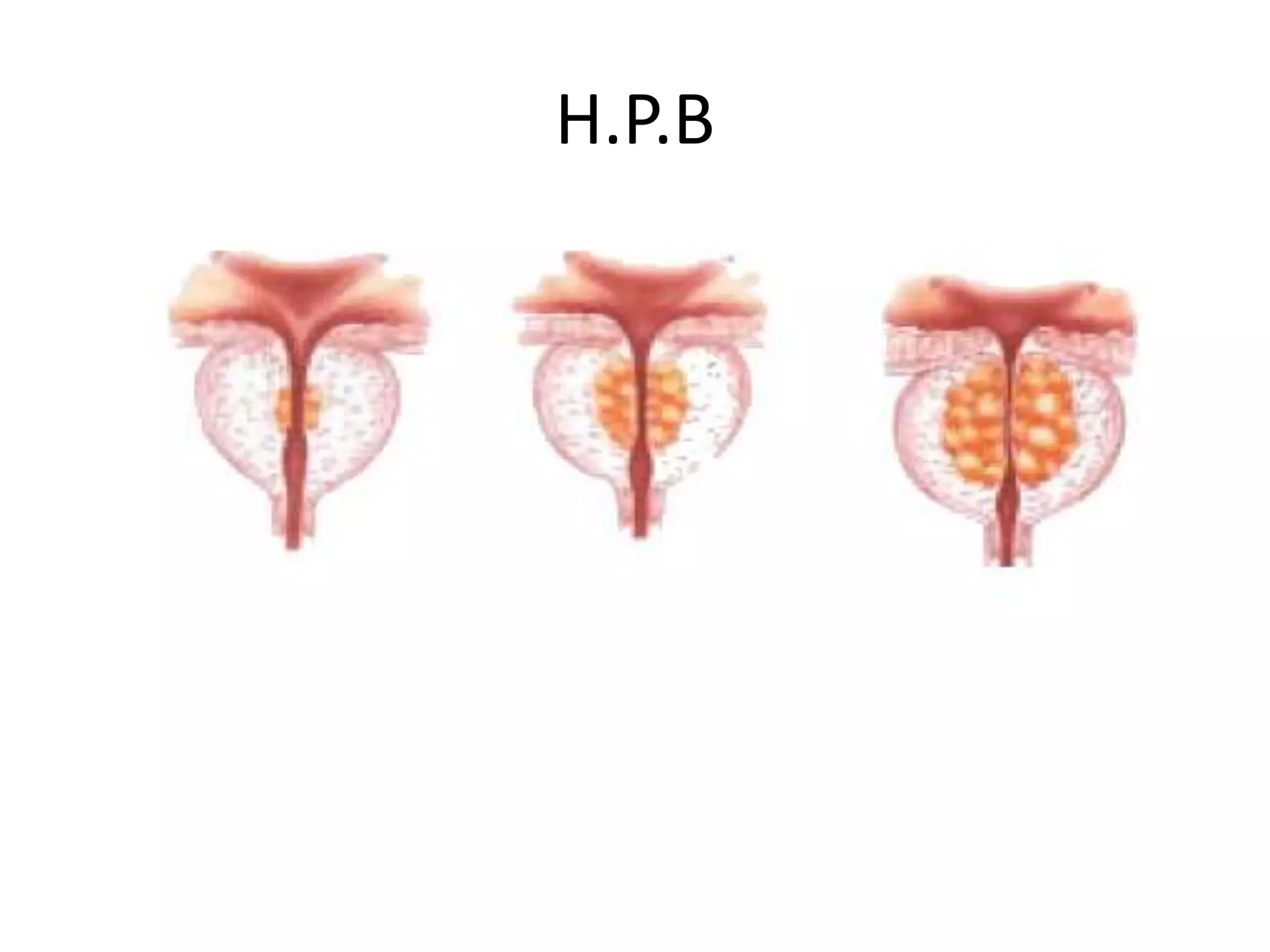 Hiperplasia Prostática Benigna y Cáncer de Próstata | PPTX | Medical Health