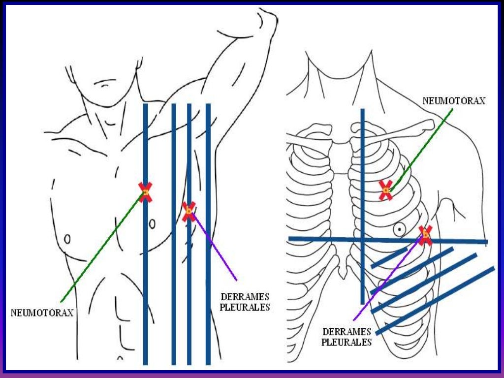 Prtactica toracocentesis