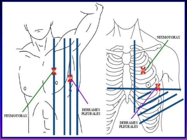 Prtactica toracocentesis