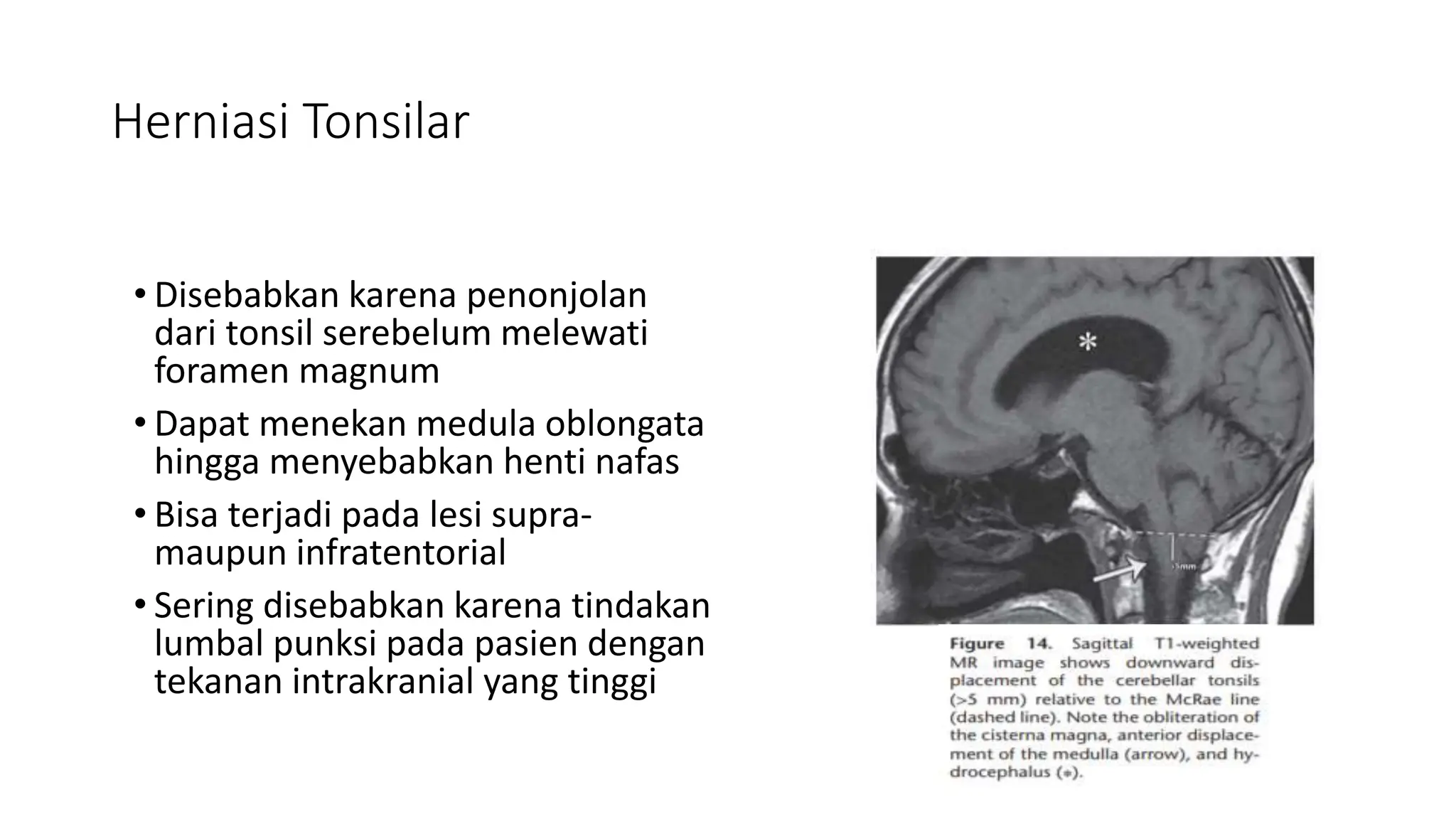 Presentasi anatomi batang otak dan cerebelum | PPTX