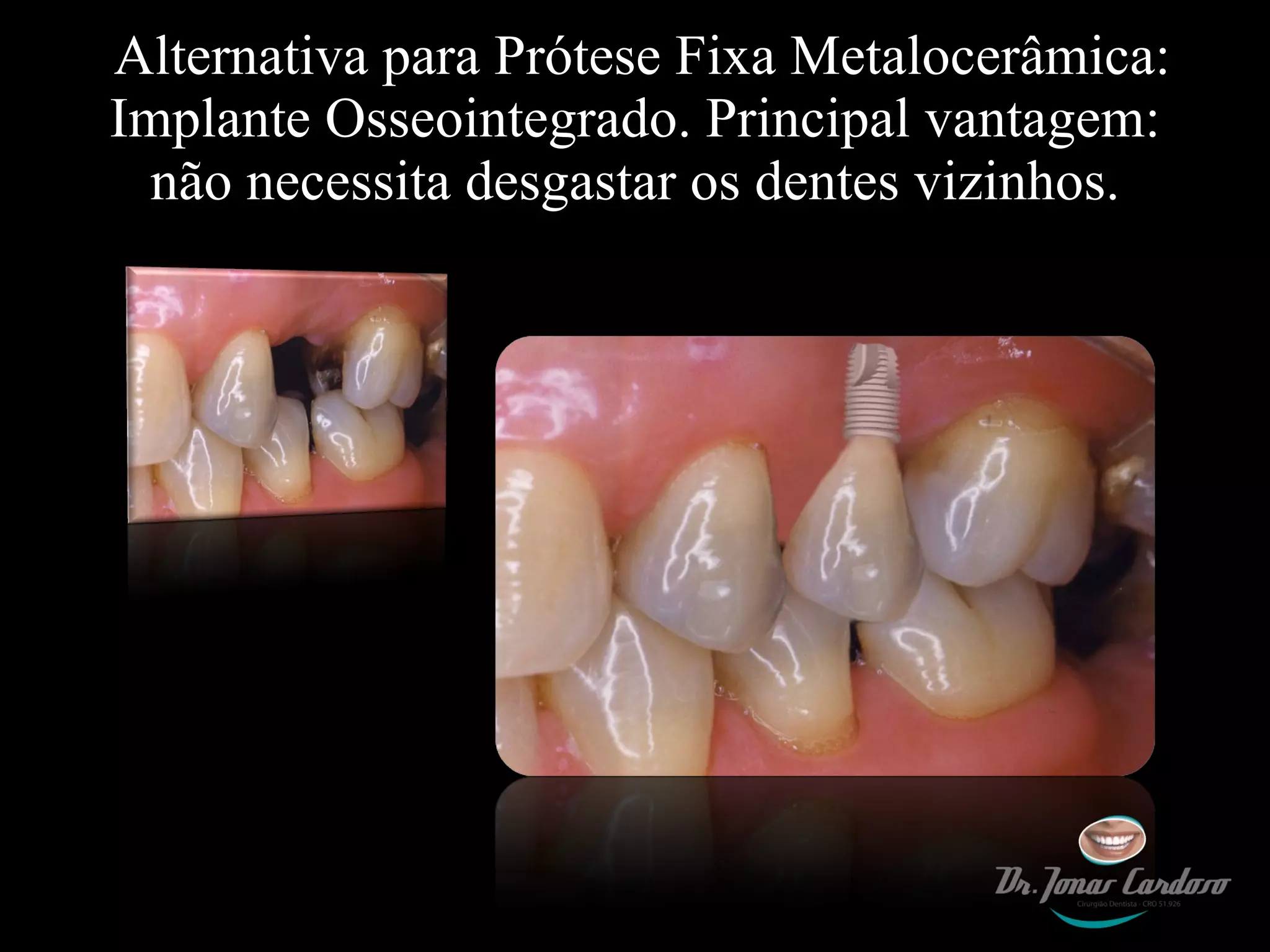 Prótese Dental Parcial Fixa Metalocerâmica | PPT