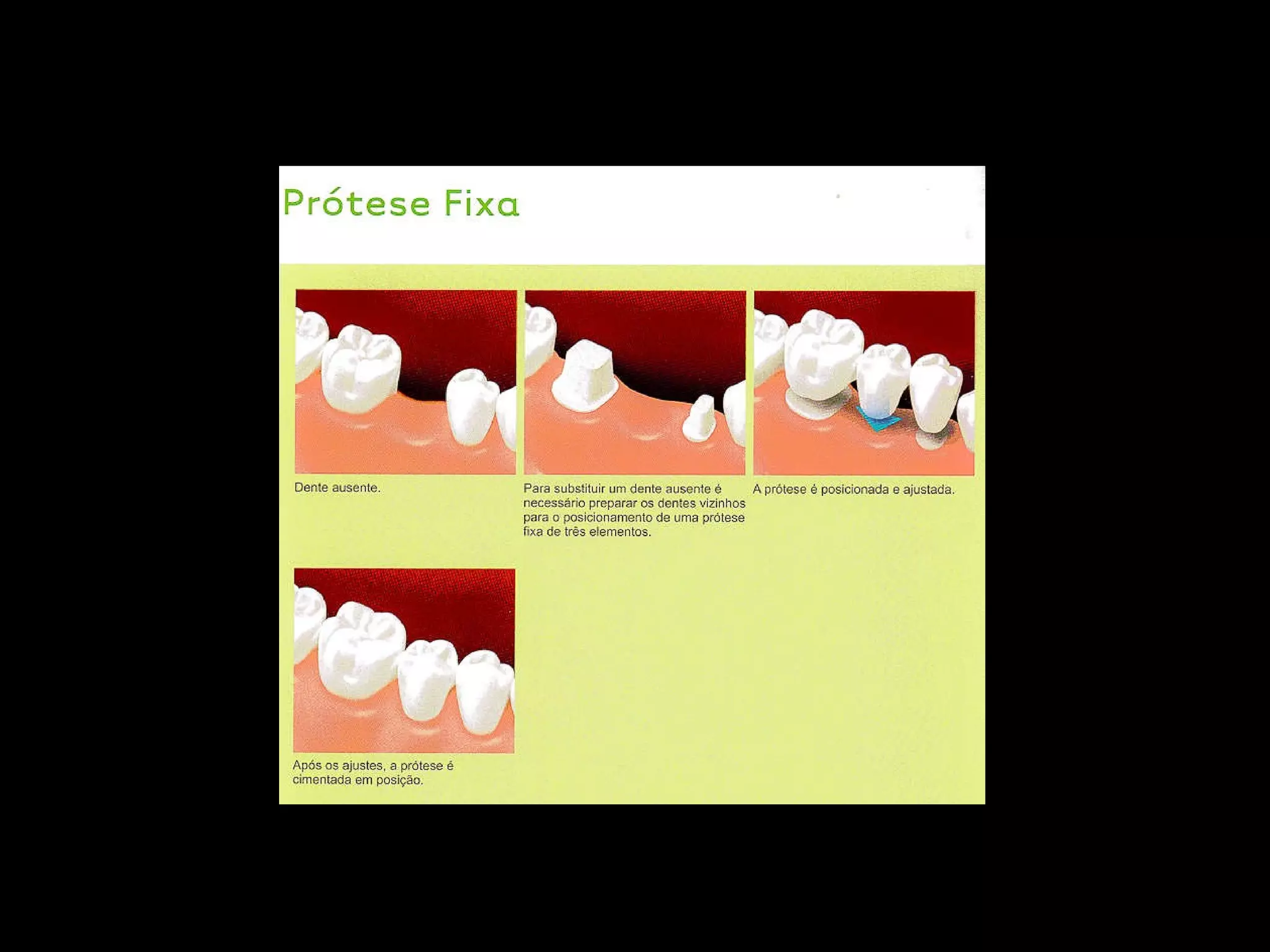 Prótese Dental Parcial Fixa Metalocerâmica | PPT