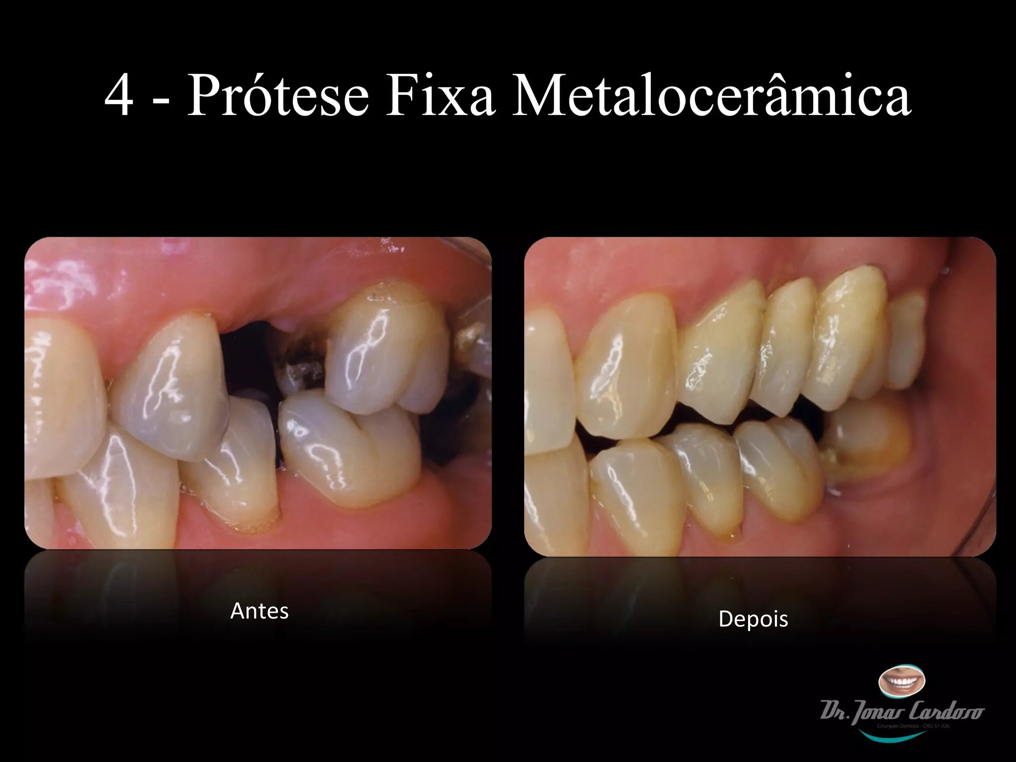 Prótese Dental Parcial Fixa Metalocerâmica | PPT