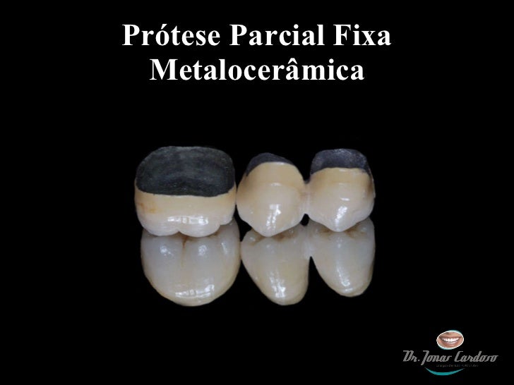 Prótese Dental Parcial Fixa Metalocerâmica