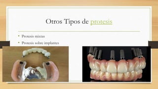 Prótesis dental | PPTX