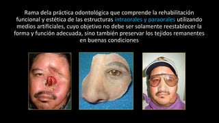 Prótesis maxilofacial | PPTX
