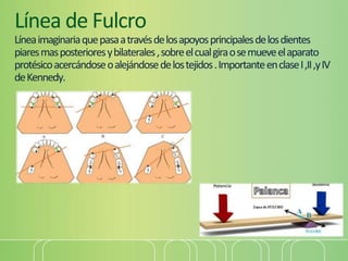 Prótesis Parcial Removible | PPTX