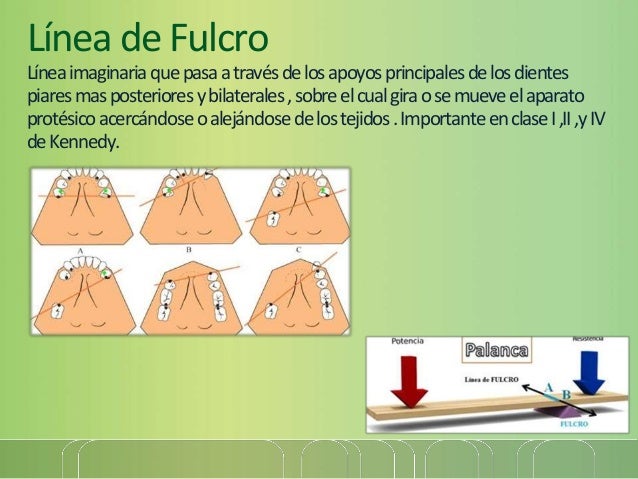 Prótesis Parcial Removible