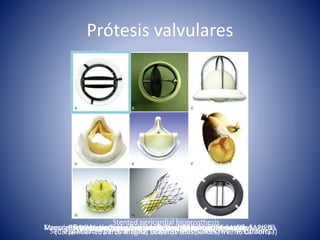 Prótesis valvulares | PPTX